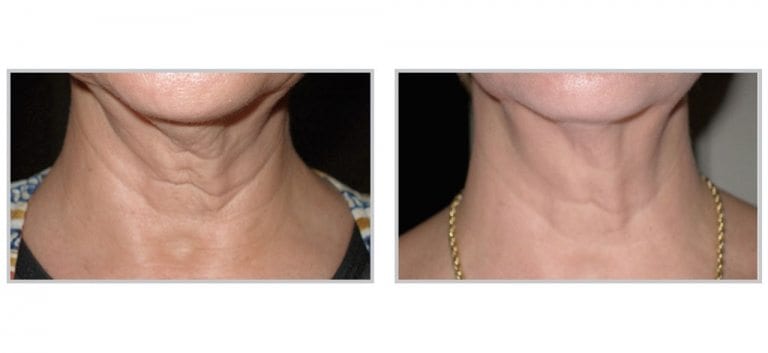 SkinTyte II | Skin Tightening Treatment in Vancouver | SkinGlow